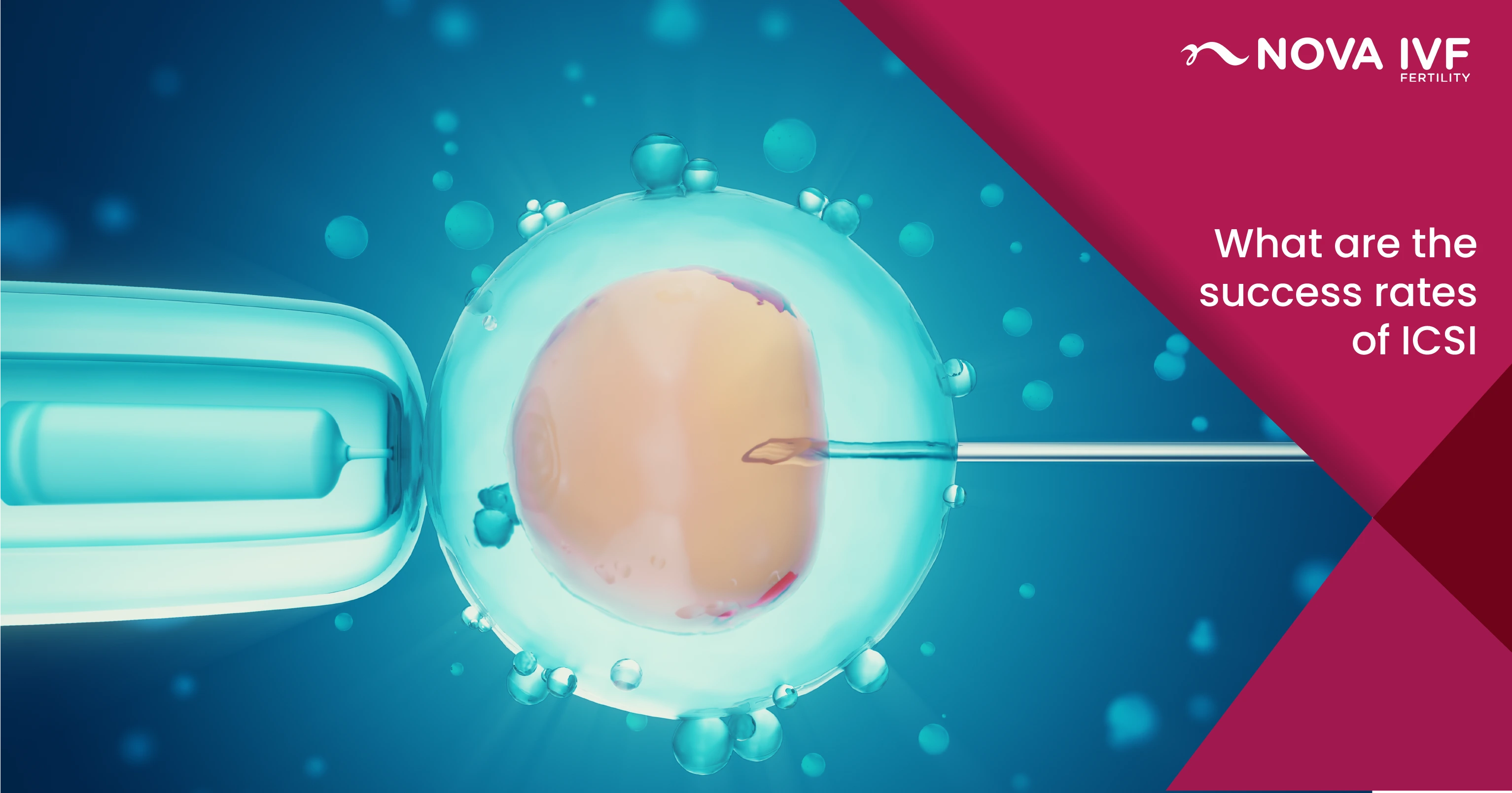 ICIS Treatment - Procedure, Benefits & Cost | Nova IVF Fertility